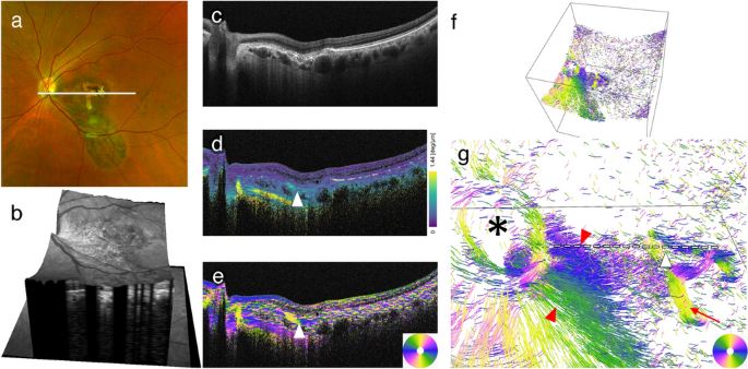 Choroidal fibrosis in secondary focal choroidal excavation detected by ...