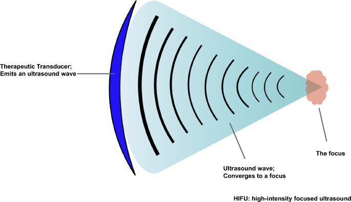 High-intensity focused ultrasound treatment for hepatocellular ...