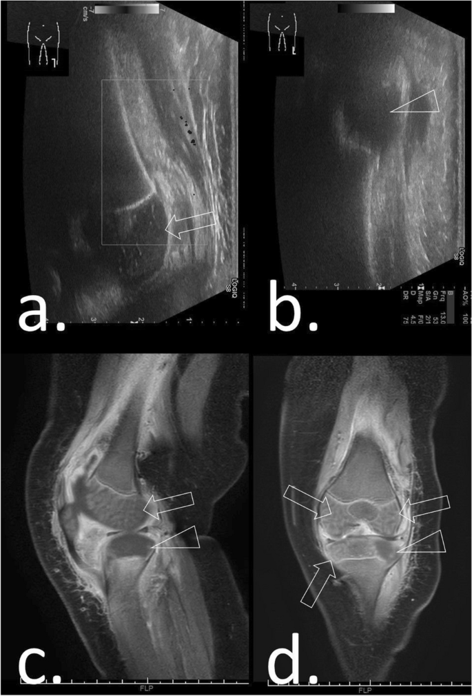 Ultrasound can provide an early assessment of infection of cartilage ...