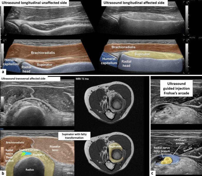 Ultrasound imaging-based diagnosis of deep branch radial nerve ...