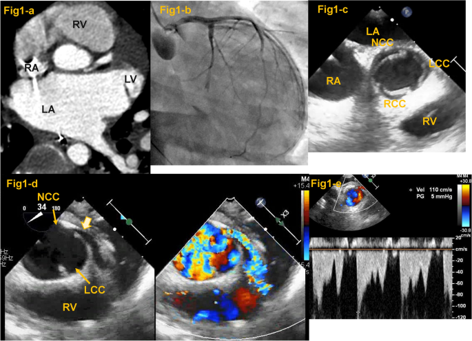 Anomalous left coronary artery from the noncoronary sinus, diagnosed ...