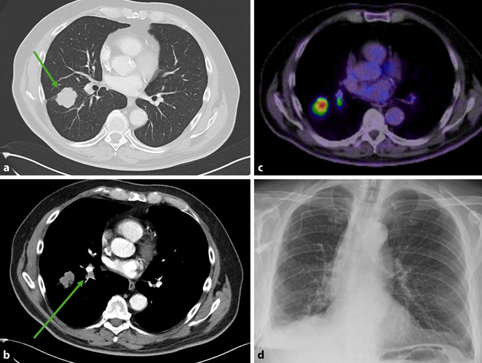 Was kann die Pneumologie von der Thoraxchirurgie erwarten ...