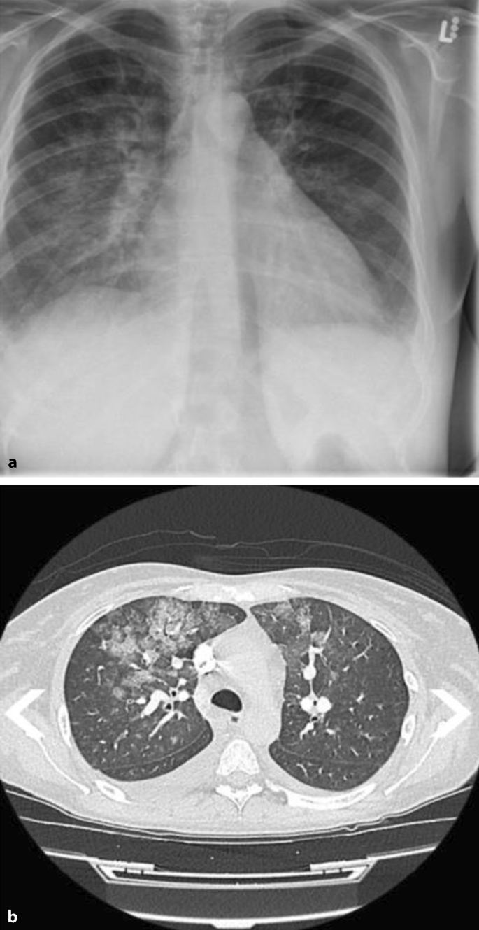 Lungenbeteiligung bei Kollagenosen | Zeitschrift für Pneumologie