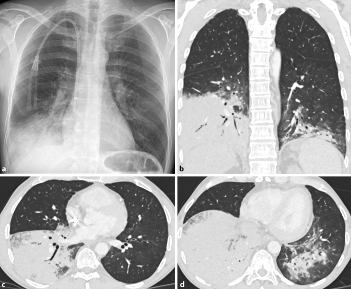 Aktuelle und neue Impfstoffe gegen Pneumokokken | Zeitschrift für ...