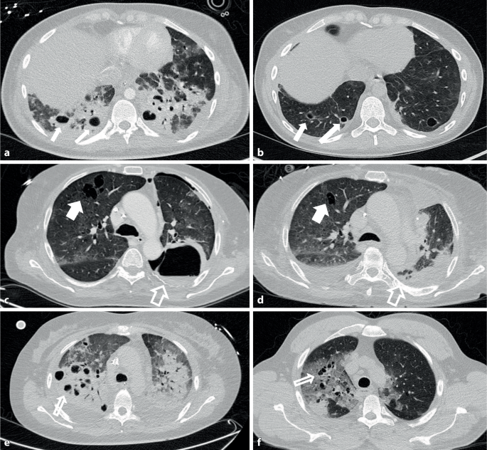 Infektiöse Ursachen und Differenzialdiagnosen zystischer ...