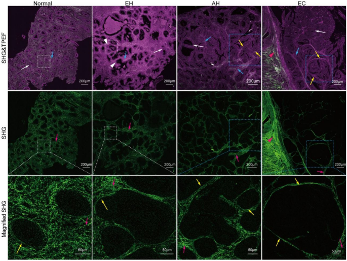 Label-Free Monitoring of Endometrial Cancer Progression Using ...