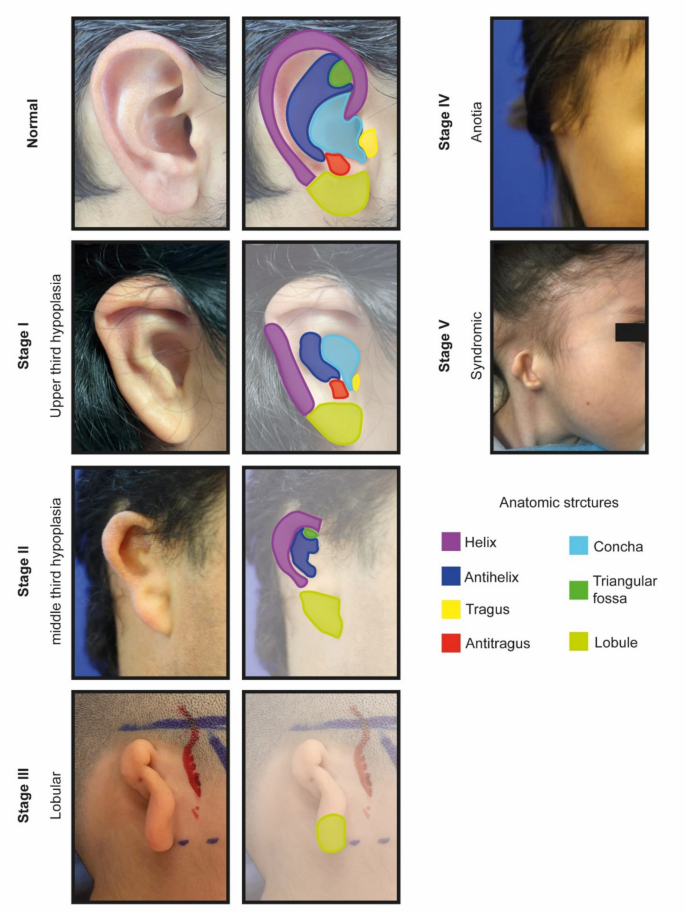 Innovative Approaches in Microtia Treatment: Advancements in Tissue ...