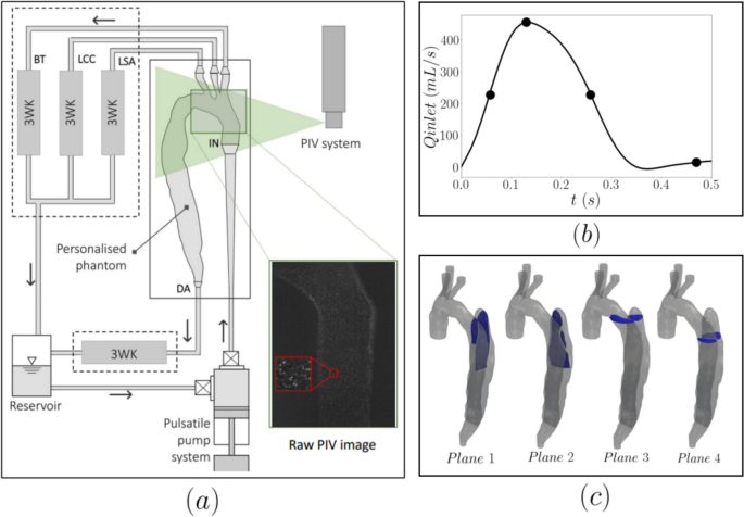 False Lumen Haemodynamics in Type B Aortic Dissection: An in Vitro ...