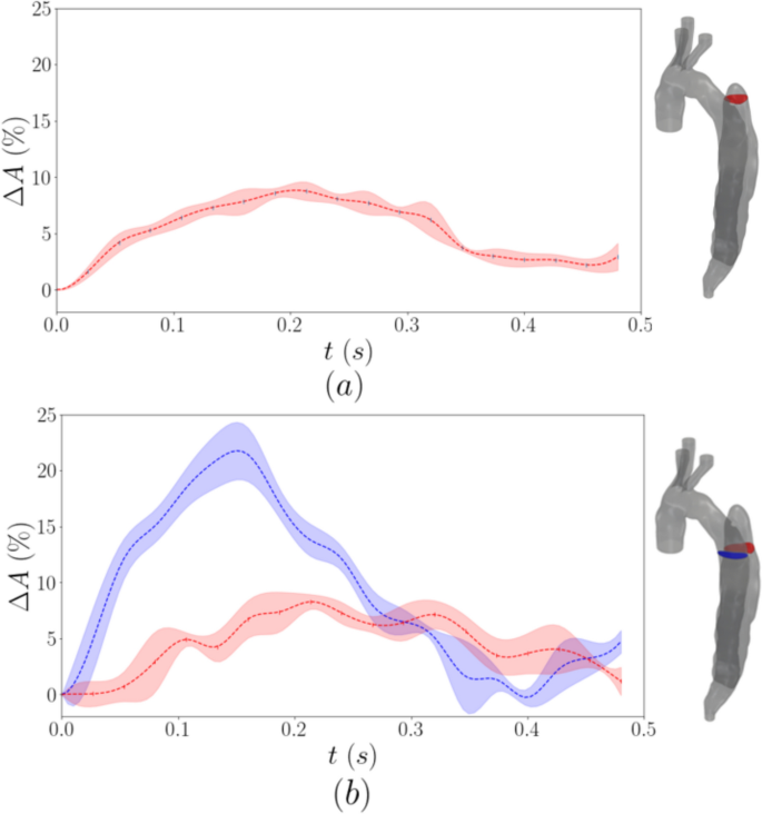 False Lumen Haemodynamics in Type B Aortic Dissection: An in Vitro ...