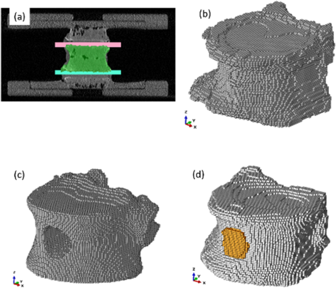 Optimization of Bone Cement Stiffness in Metastatic Vertebral ...
