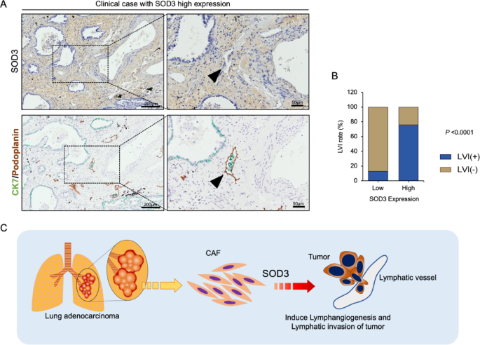 Cancer-associated fibroblast-derived SOD3 enhances lymphangiogenesis to ...