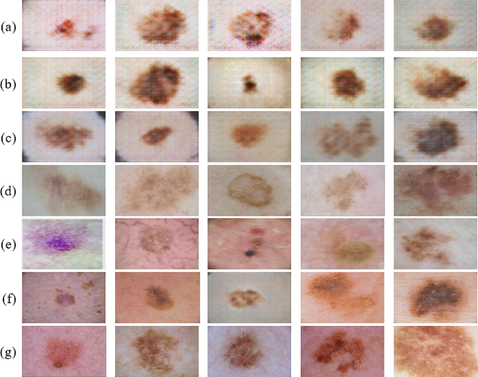 GAN based augmentation using a hybrid loss function for dermoscopy images | Artificial ...