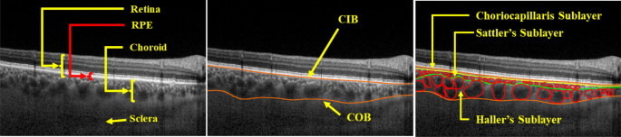 Artificial intelligence in choroid through optical coherence tomography ...