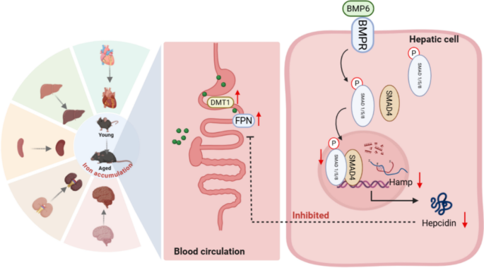 High intestinal iron absorption induced by decreased hepcidin leads to ...