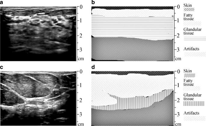Classification of breast tissues on ultrasound images | Biomedical ...