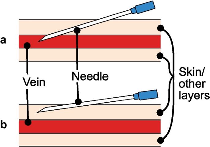 Non-contact sensor module for rapid detection of extravasation during ...