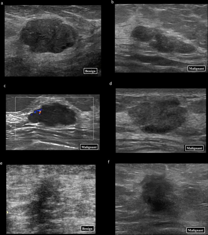 Machine learning can reliably predict malignancy of breast lesions ...