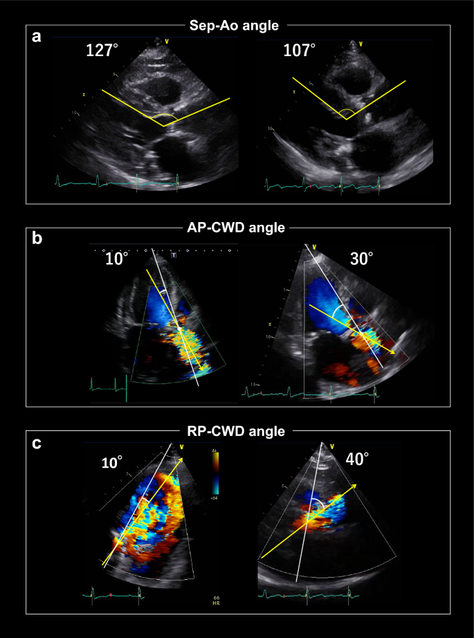 Predominant determinants for evaluation of right parasternal approach ...