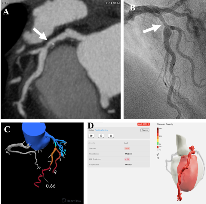 Invasive fractional-flow-reserve prediction by coronary CT angiography using artificial ...