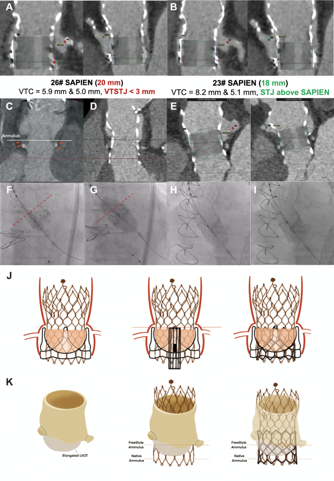 Role of imaging in third aortic valve implantation: TAV-in-TAV-in-SAV ...
