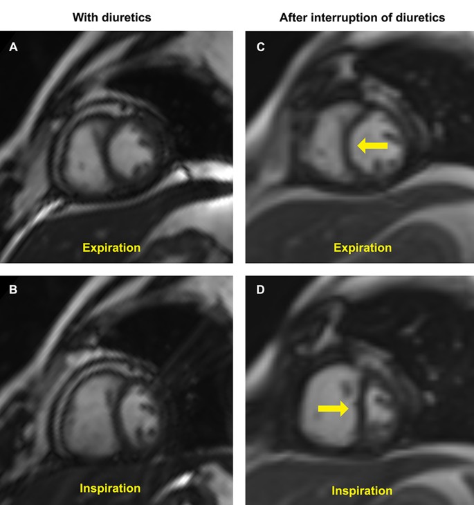 Overcoming diagnostic challenges in constrictive pericarditis: why ...