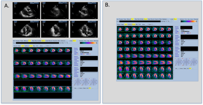 ECHO-MPS, a dual modality strategy of cardiac imaging to identify ...