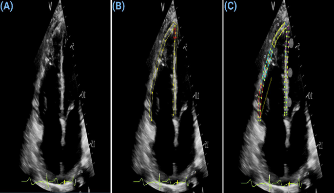 Right ventricular strain enhances the REVEAL LITE score for predicting ...