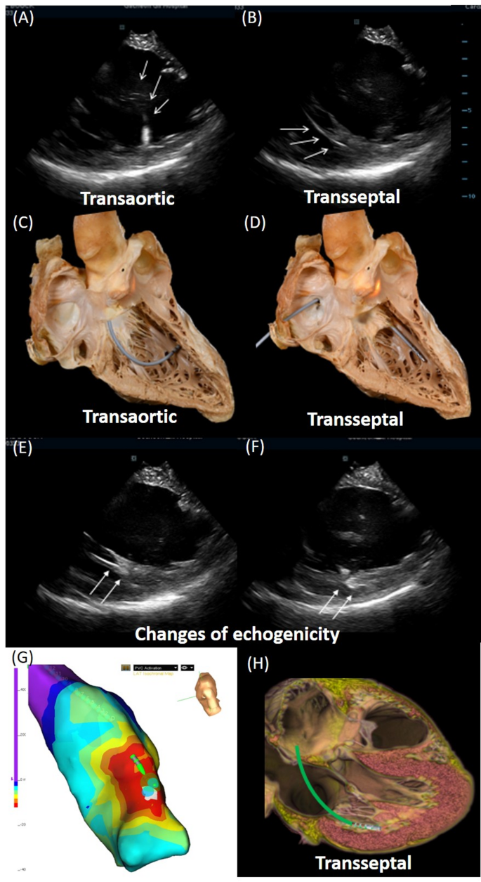 Key role of intracardiac echocardiography in catheter ablation of ...