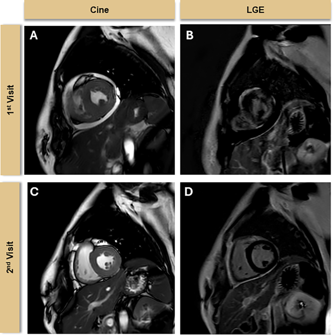 Longitudinal cardiac MRI assessment in constrictive pericarditis: a case series | The ...