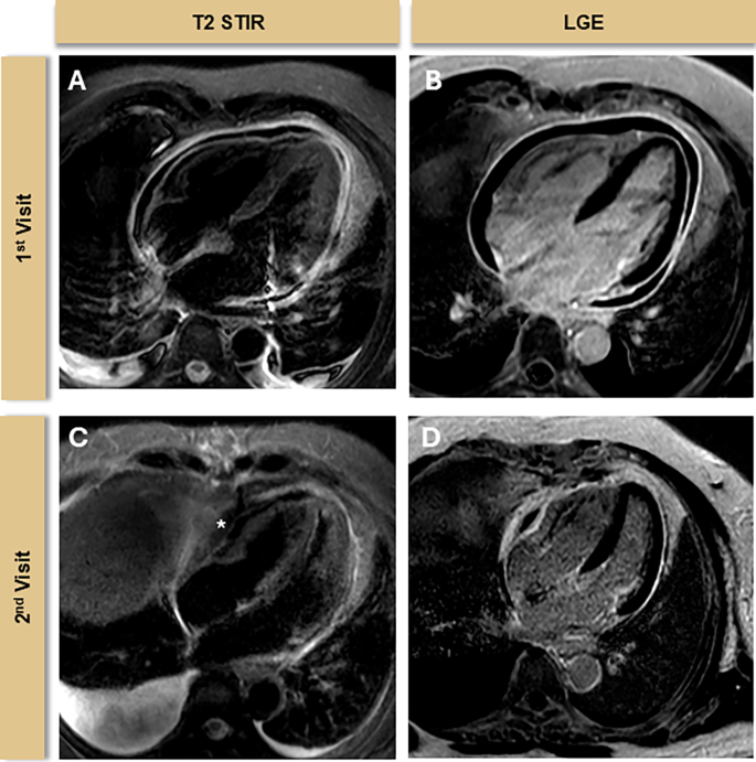 Longitudinal cardiac MRI assessment in constrictive pericarditis: a ...