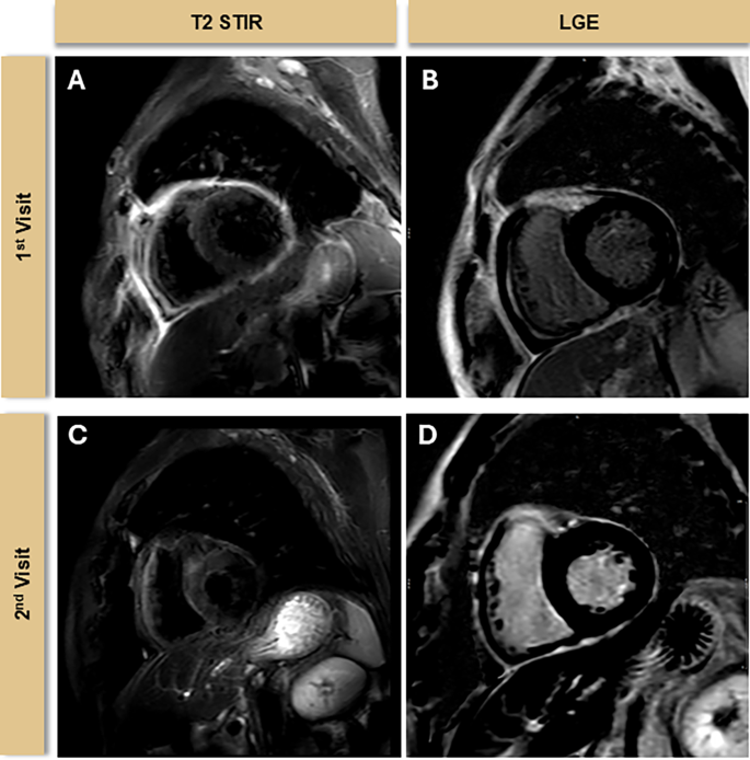 Longitudinal cardiac MRI assessment in constrictive pericarditis: a ...