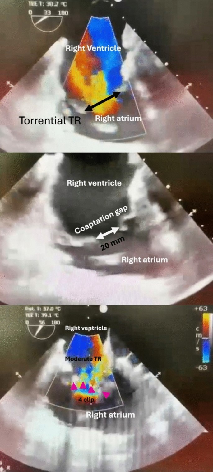 Efficacy and Safety of TriClip Procedure in Patients with Severe ...