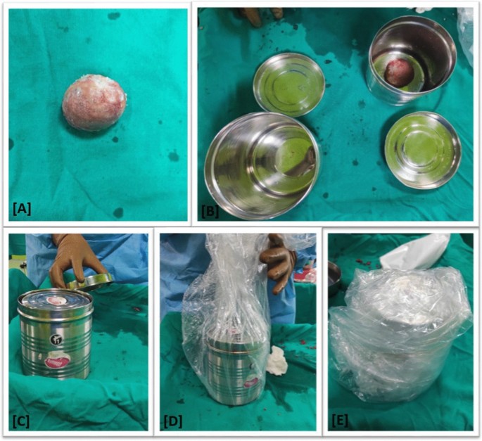 Establishing a bone bank within a hospital setting in India: early ...