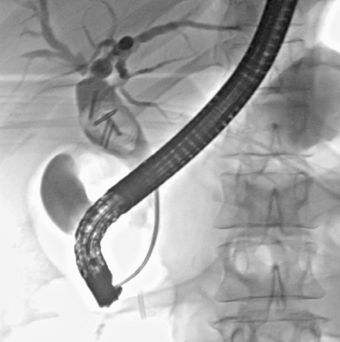 Cholangioscopy Assisted Electrohydraulic Lithotripsy for the Rescue of ...