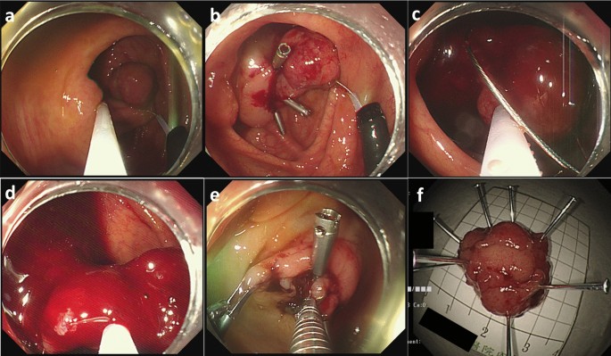 Double-Scope and Double-Snare Techniques for Endoscopic Resection ...