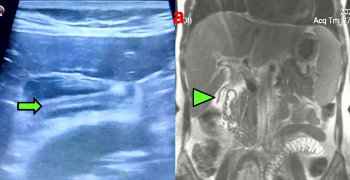Standalone Gall Bladder Ascariasis: An Unusual Sanctuary Site ...