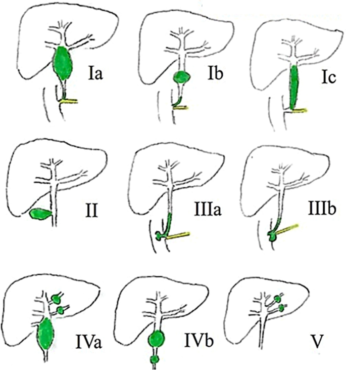Diagnosis and Treatment of Choledochal Cysts: A Comprehensive Review ...