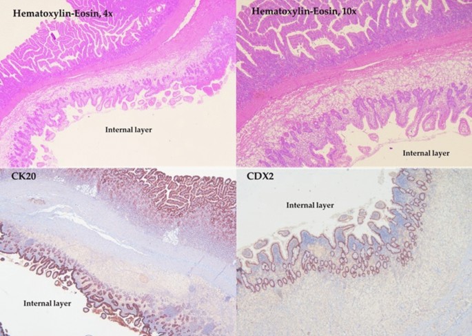 Diagnosis and Treatment of Choledochal Cysts: A Comprehensive Review ...