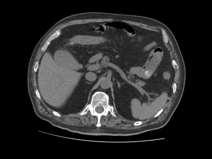 Blue Rubber Bleb Nevus Syndrome Causing Small Bowel Bleeding ...