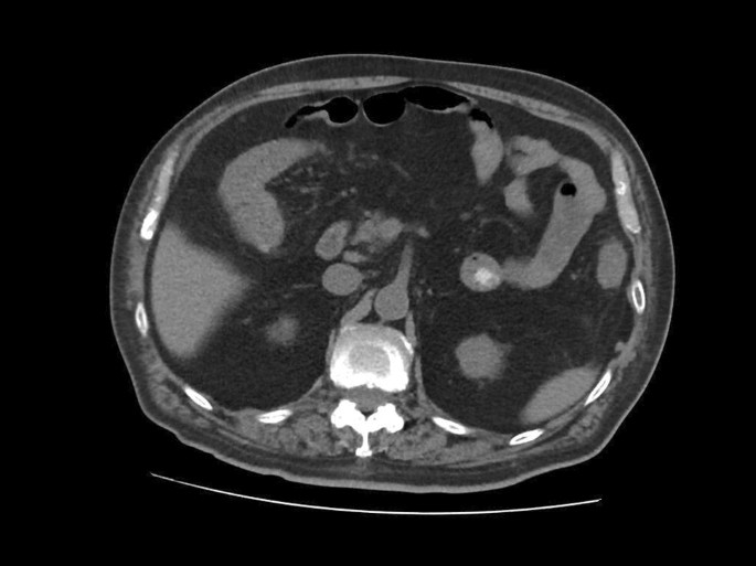 Blue Rubber Bleb Nevus Syndrome Causing Small Bowel Bleeding ...