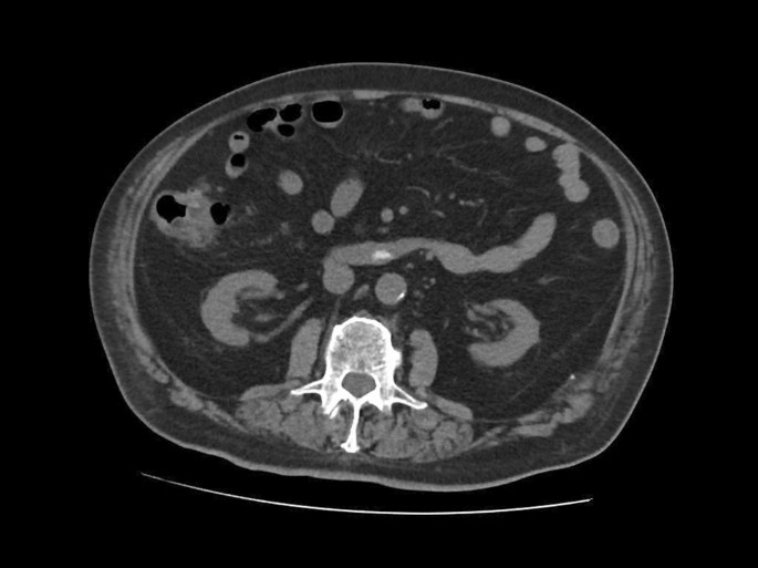 Blue Rubber Bleb Nevus Syndrome Causing Small Bowel Bleeding ...