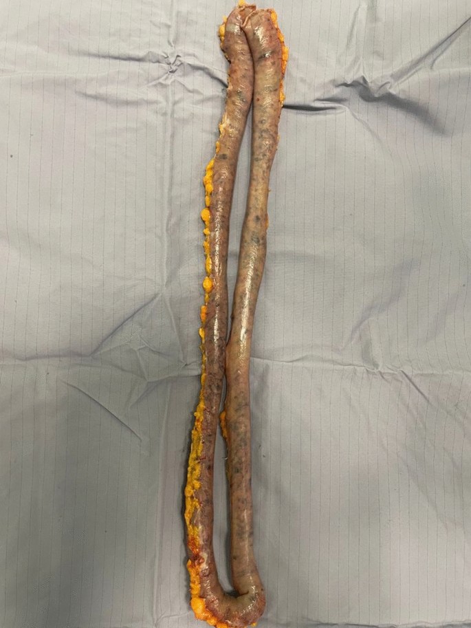 Blue Rubber Bleb Nevus Syndrome Causing Small Bowel Bleeding ...