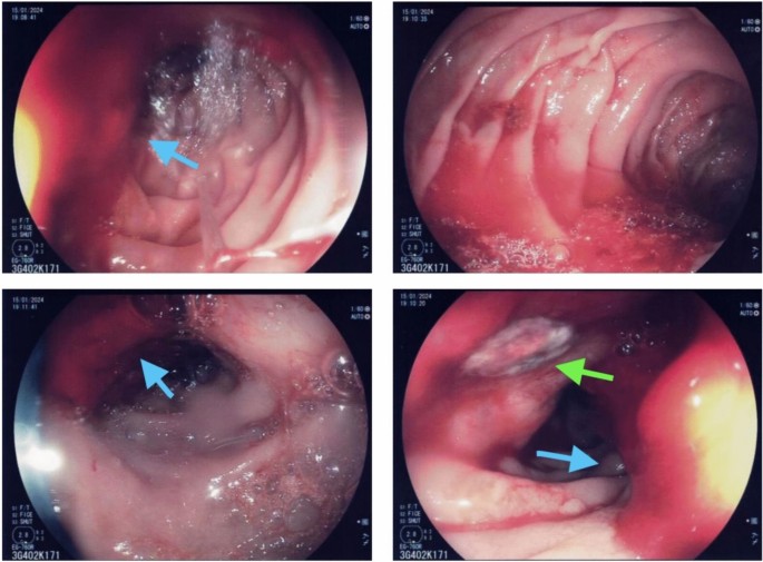 A Soft Spot for Bleeding: Pseudoaneurysm of the Gastroduodenal Artery ...