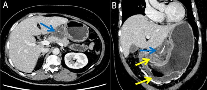 Fish Bone-Induced Gastric Perforation and Abscess Formation | Digestive ...