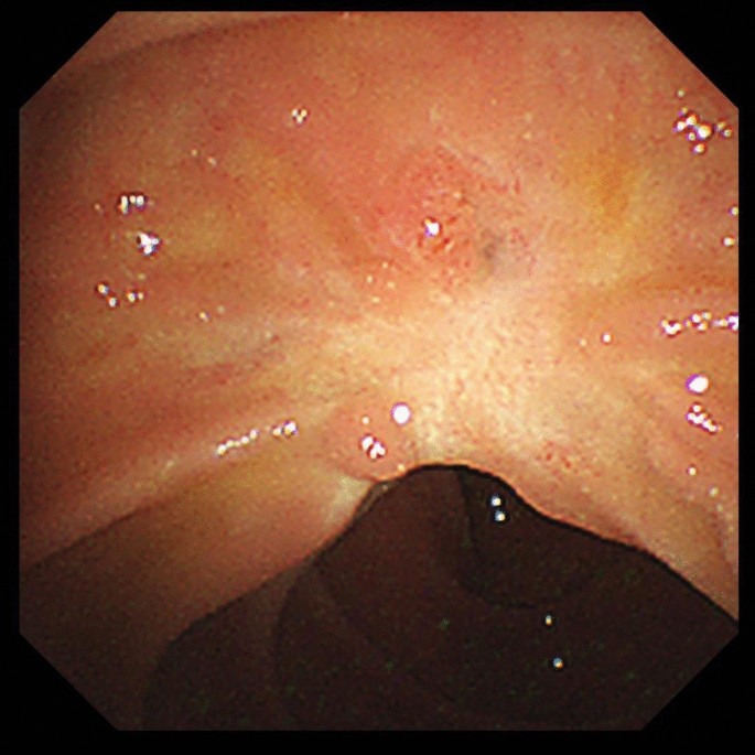 Endoscopic Submucosal Dissection Followed by Endoscopic Full-Thickness ...