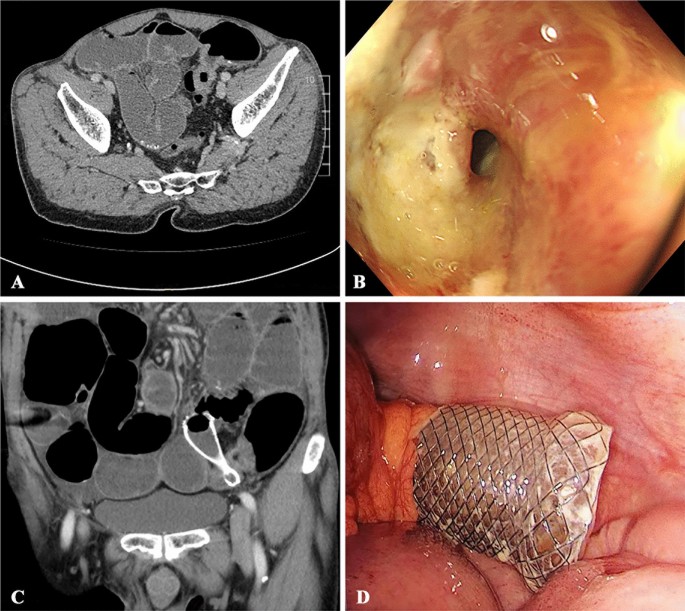 Perforation that Occurred Right After Sigmoid Colon Cancer Stenting ...