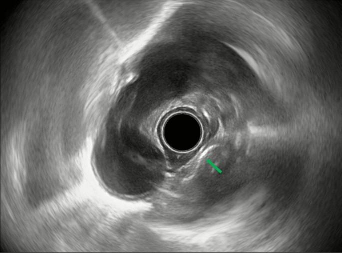 Thoracic Vertebral Osteophyte as an Unusual Cause of Dysphagia ...