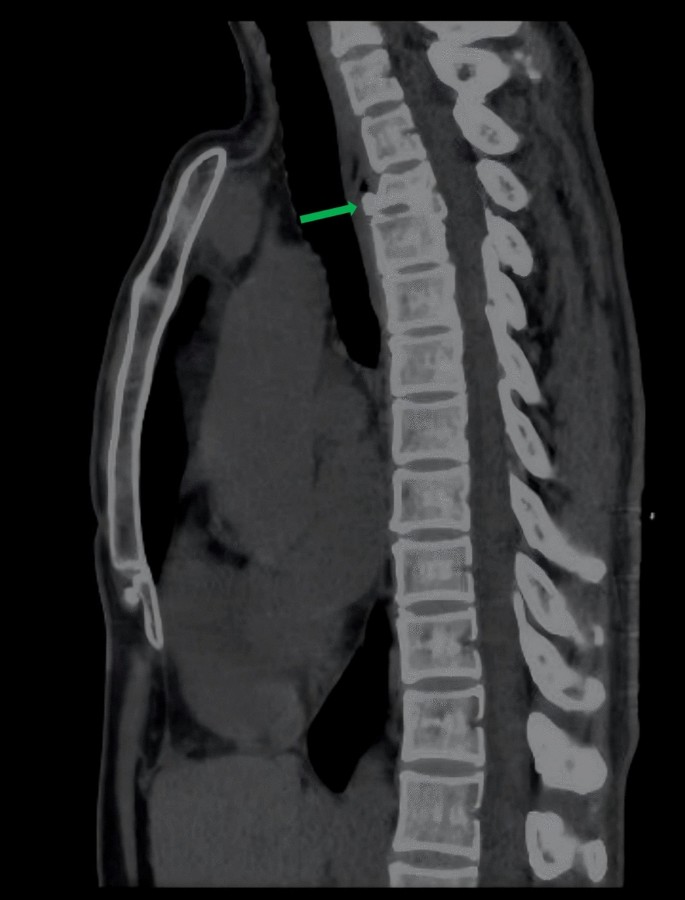 Thoracic Vertebral Osteophyte as an Unusual Cause of Dysphagia ...