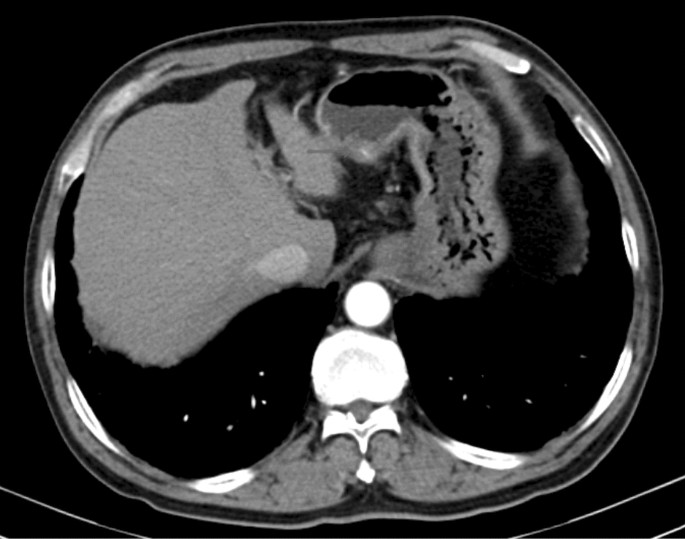 Fish Bone in the Gastric Wall: A Diagnostic Pitfall in Endoscopic ...