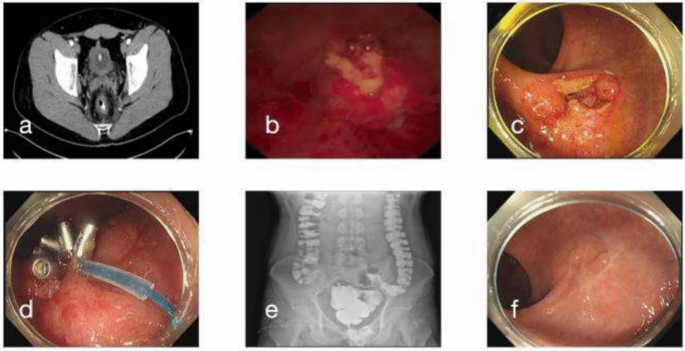 Combined “Double-Tube” Endoscopic Purse-String Closure for Traumatic ...